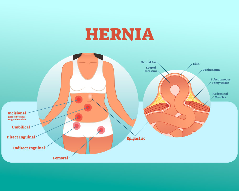 Understanding The Different Types Of Hernia Surgeries Surgical Understanding The Different Types Of Hernia Surgeries Surgical